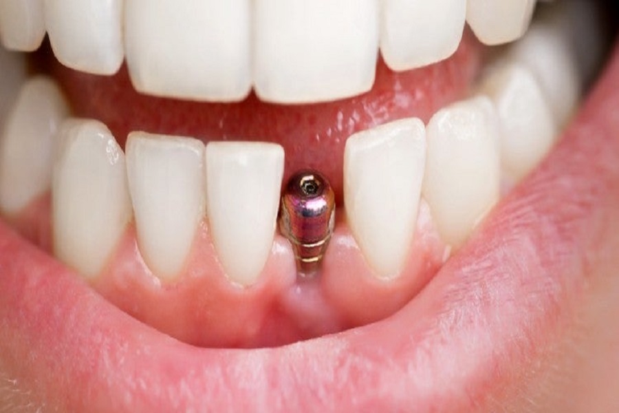 Introduction Of MBT Straight Wire Arch Correction Technique - PANDA ORAL