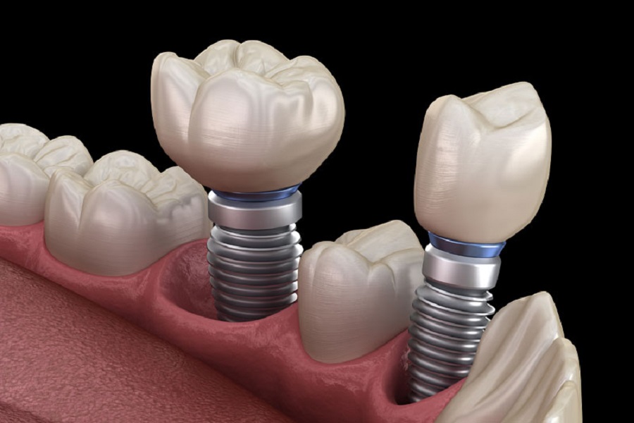 How Long Does It Take To Get A Dental Implant After A Tooth Extraction how-long-does-it-take-to-get-a-dental-implant-after-a-tooth-extraction