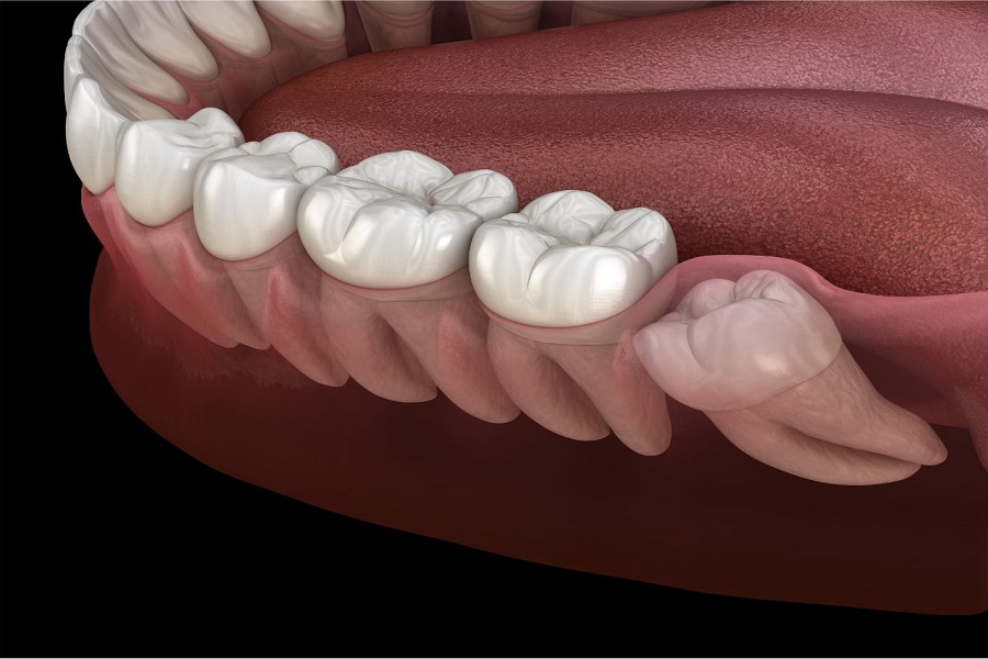 Does Wisdom Tooth Extraction Hurt? Teeth Are Sideways - PANDA ORAL