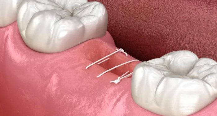 Stitches After Wisdom Teeth Removal：Everything You Need To Know - PANDA ...